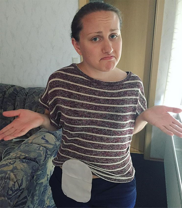 زندگی با کیسه کلستومی!